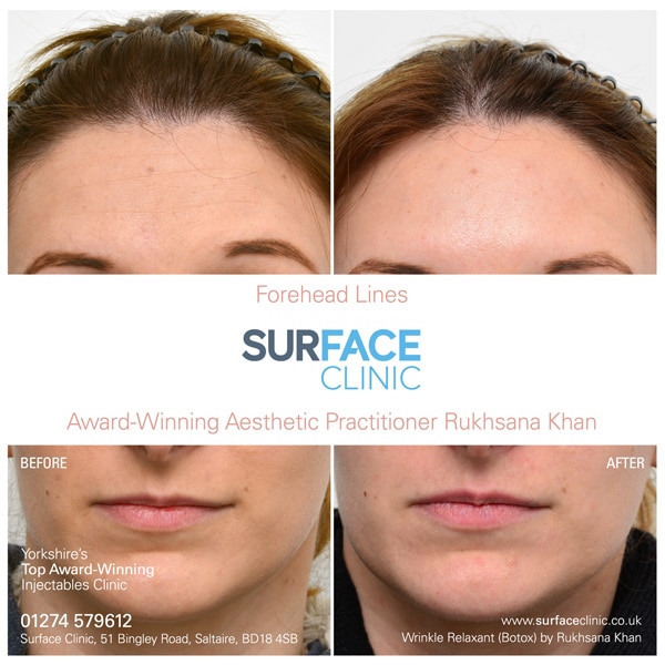 Botox - Surface Clinic
