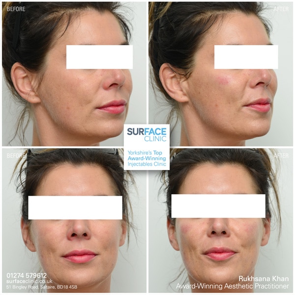 Botox - Surface Clinic