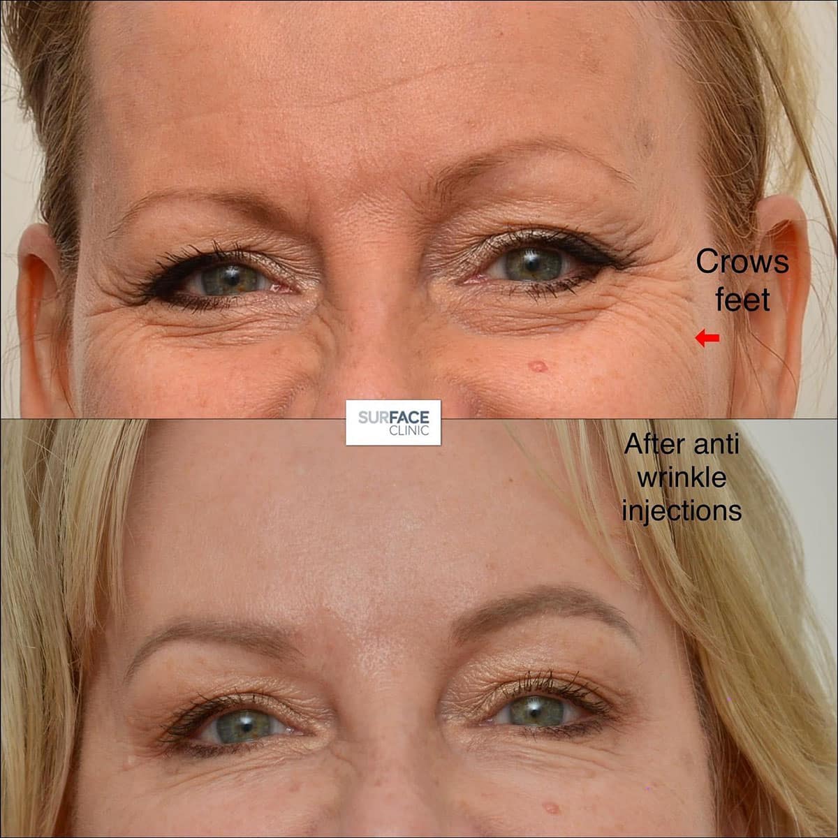 Botox - Surface Clinic