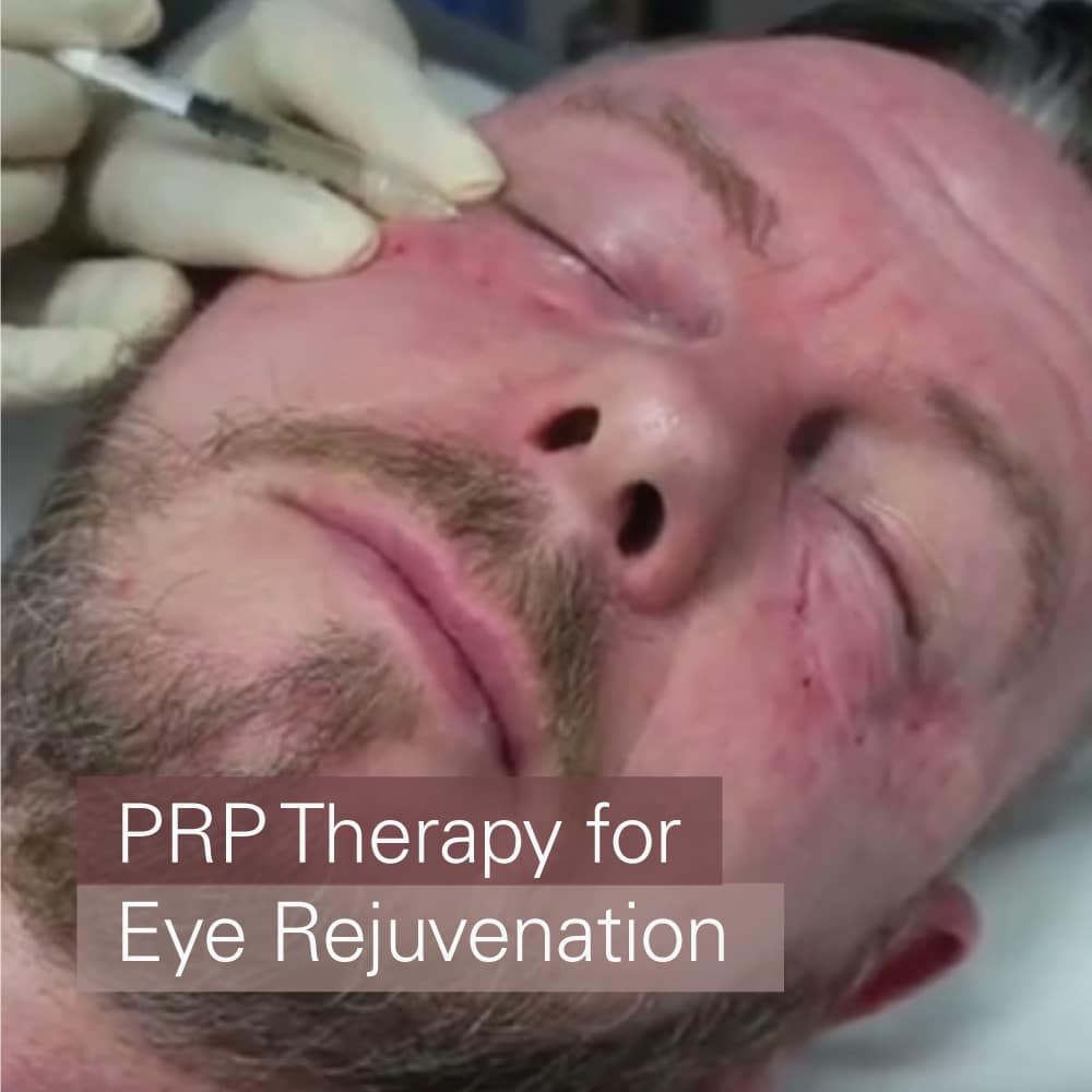 PRP Vampire Facial Bradford - Natural Skin Renewal