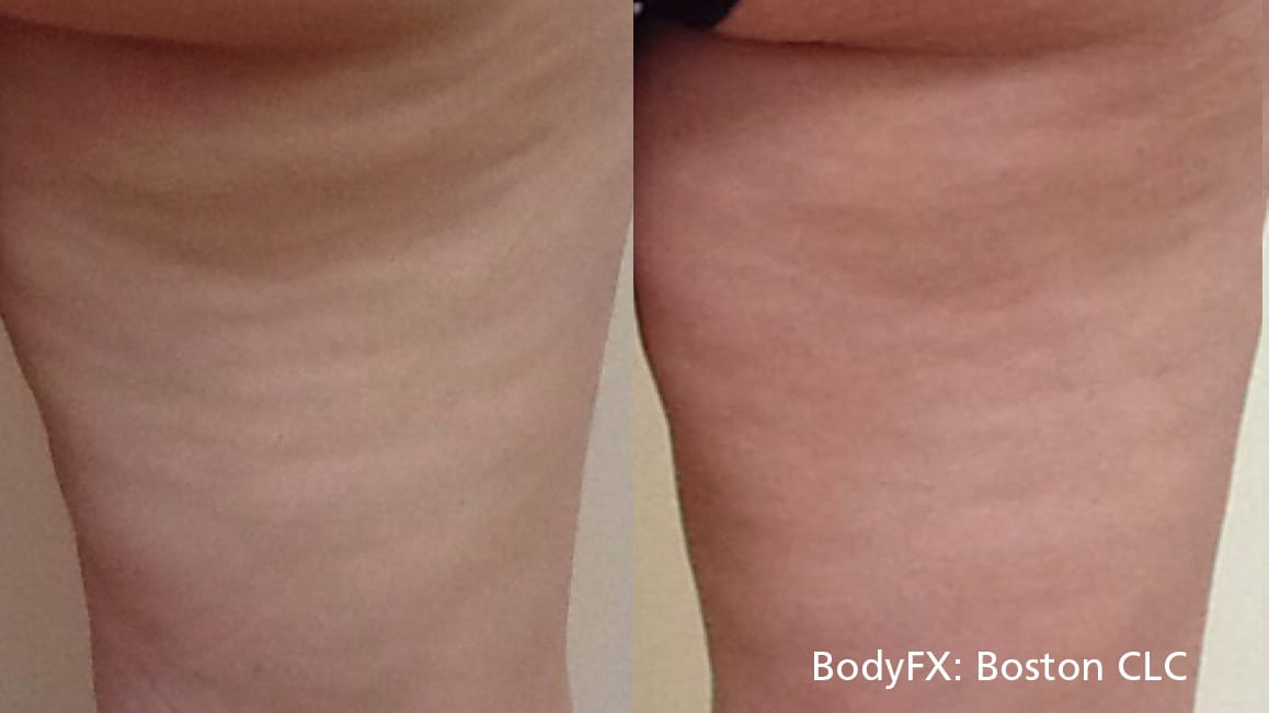 Inmode BodyFX Bradford - Target Fat & Reduce Cellulite